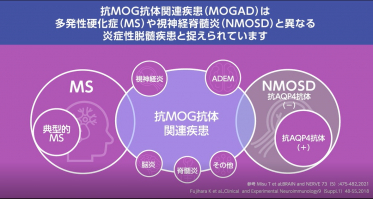 【動画】抗MOG抗体の測定up to date -東北大学より技術移管されたLiveCBA法の特徴と意義- | コスミックコーポレーション