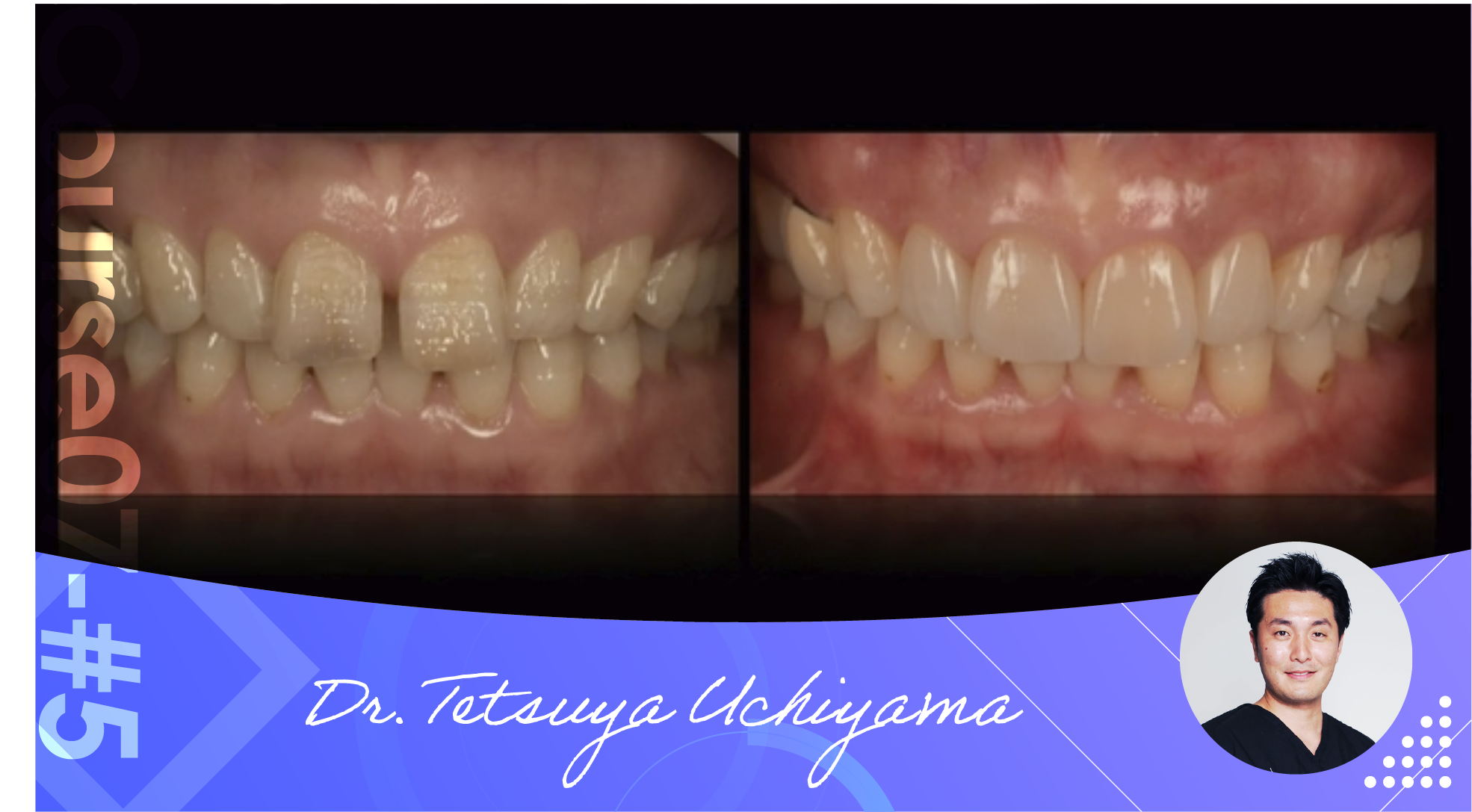 #5 Table top venner, clinical case | Doctorbook global academy