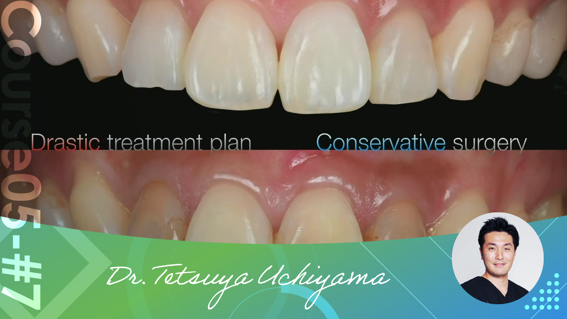 #7 direct bonding | Doctorbook global academy