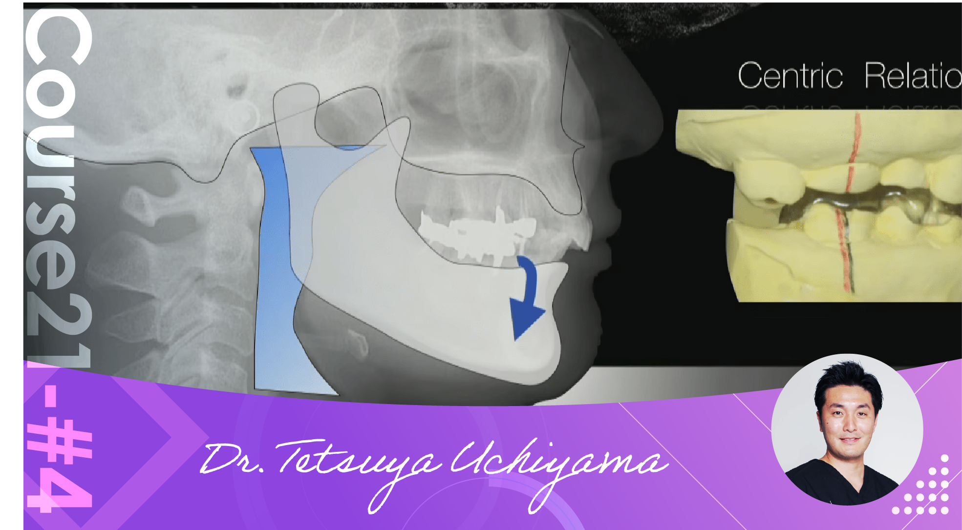 #4 Case of occlusal collapse of molars | Doctorbook global academy