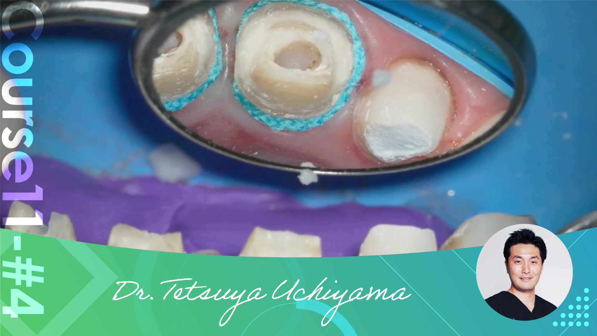 #4 Preparation of abutment teeth and root canal filling about Internal ...