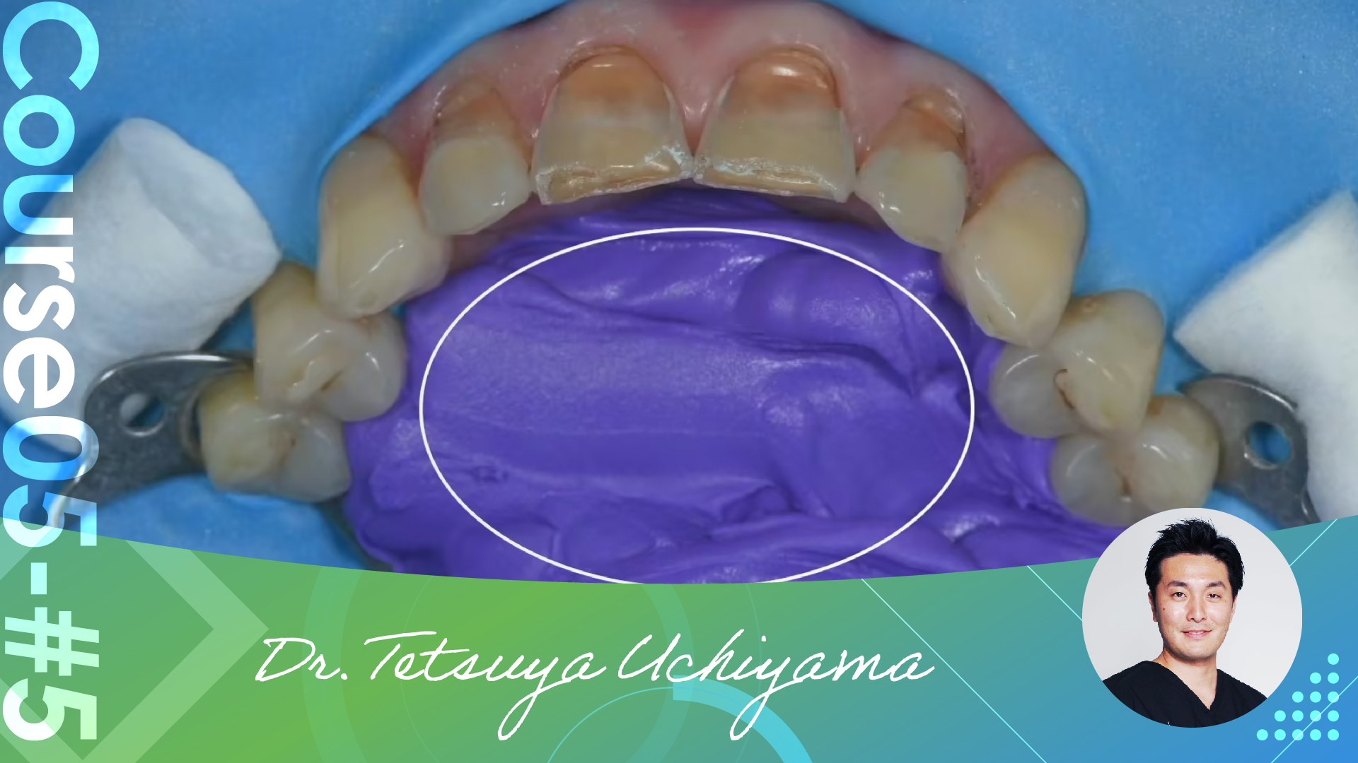 #5 split dam technique | Doctorbook global academy