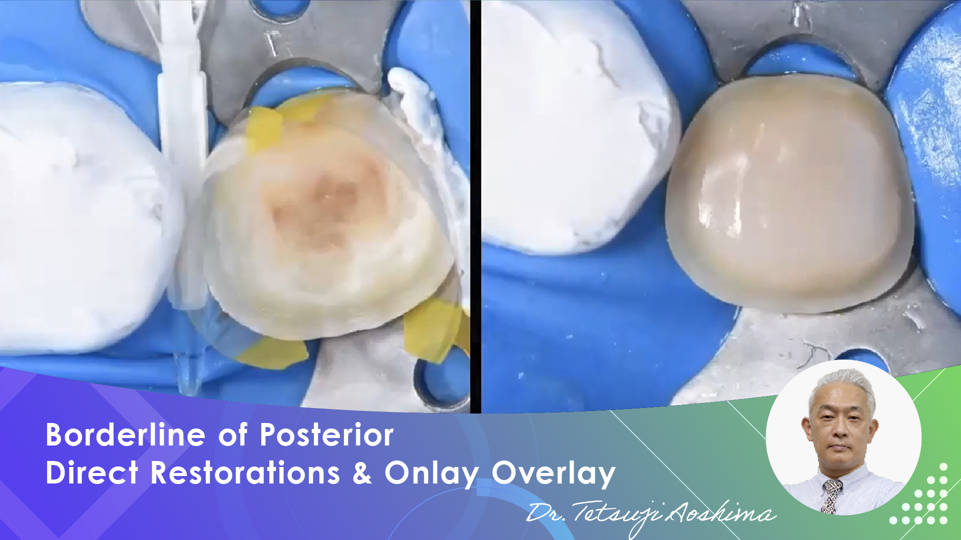 【Watch a free sample video】Borderline of Posterior Direct Restorations ...