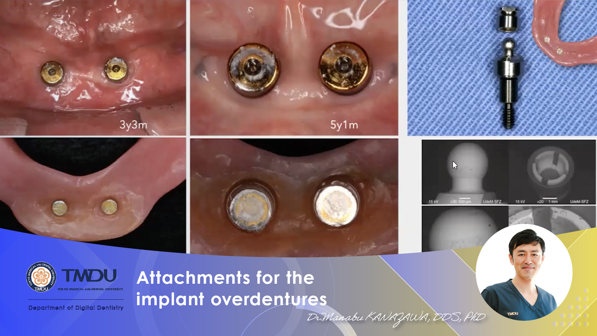 Attachments for the implant overdentures | Doctorbook global academy