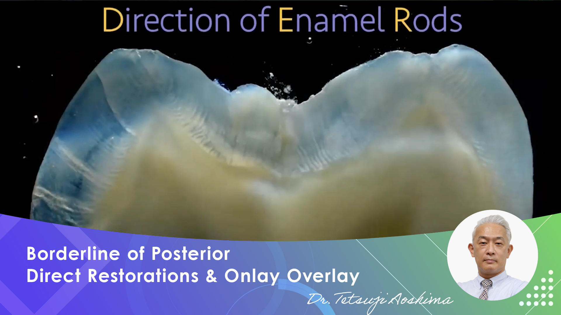 Borderline of Posterior Direct Restorations and Onlay Overlay ...