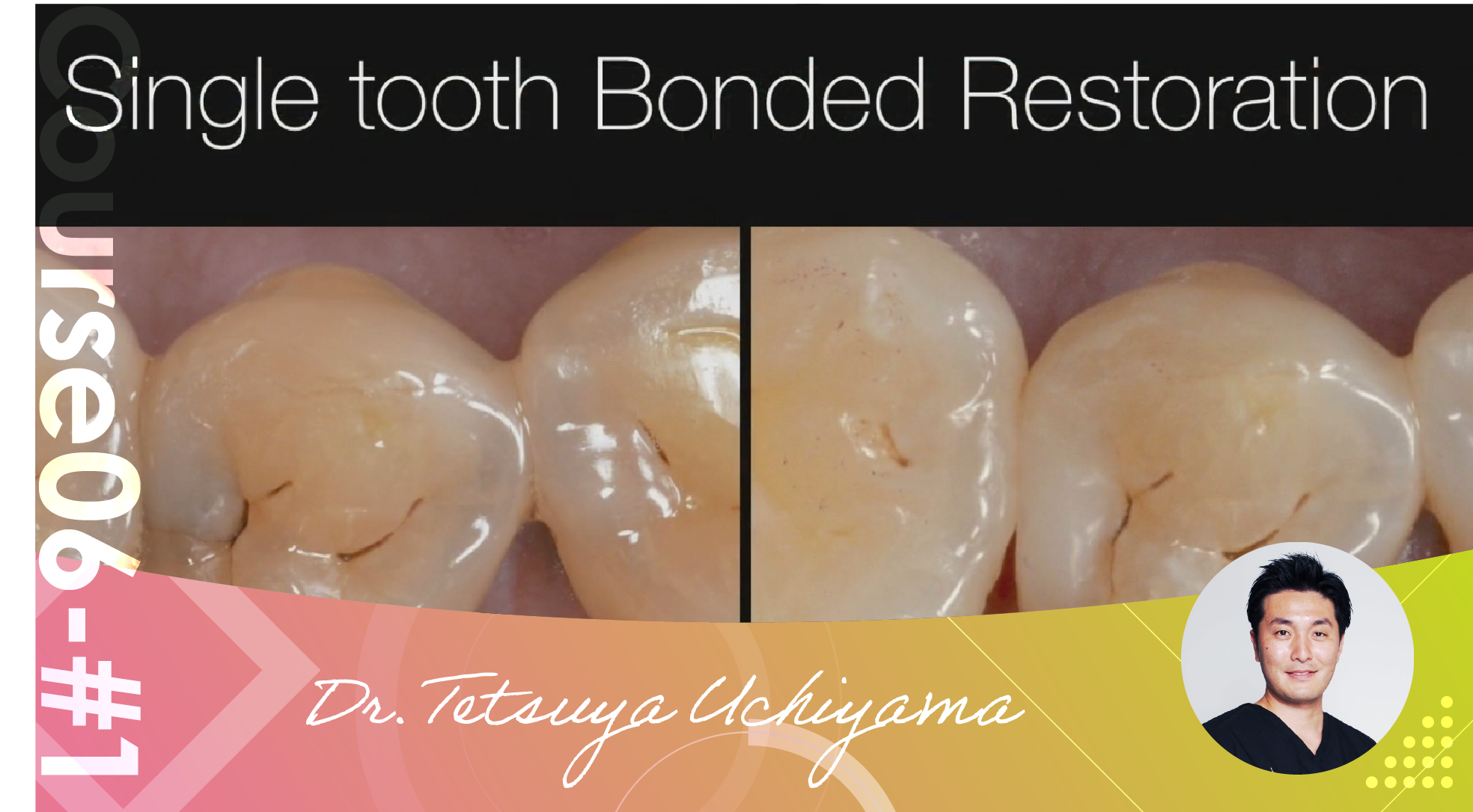 #1 Bonded Restoration, the advantages of using micro for bonding ...