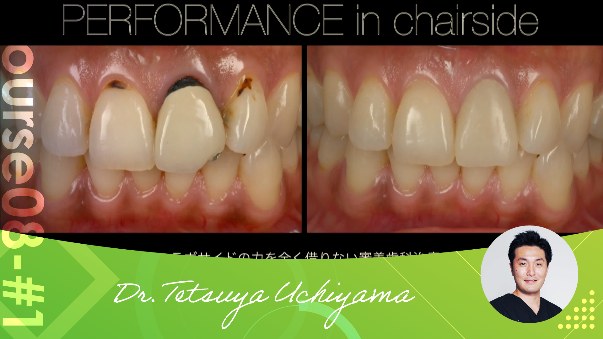 #1 Advanced bonded restoration with little or no tooth reduction ...