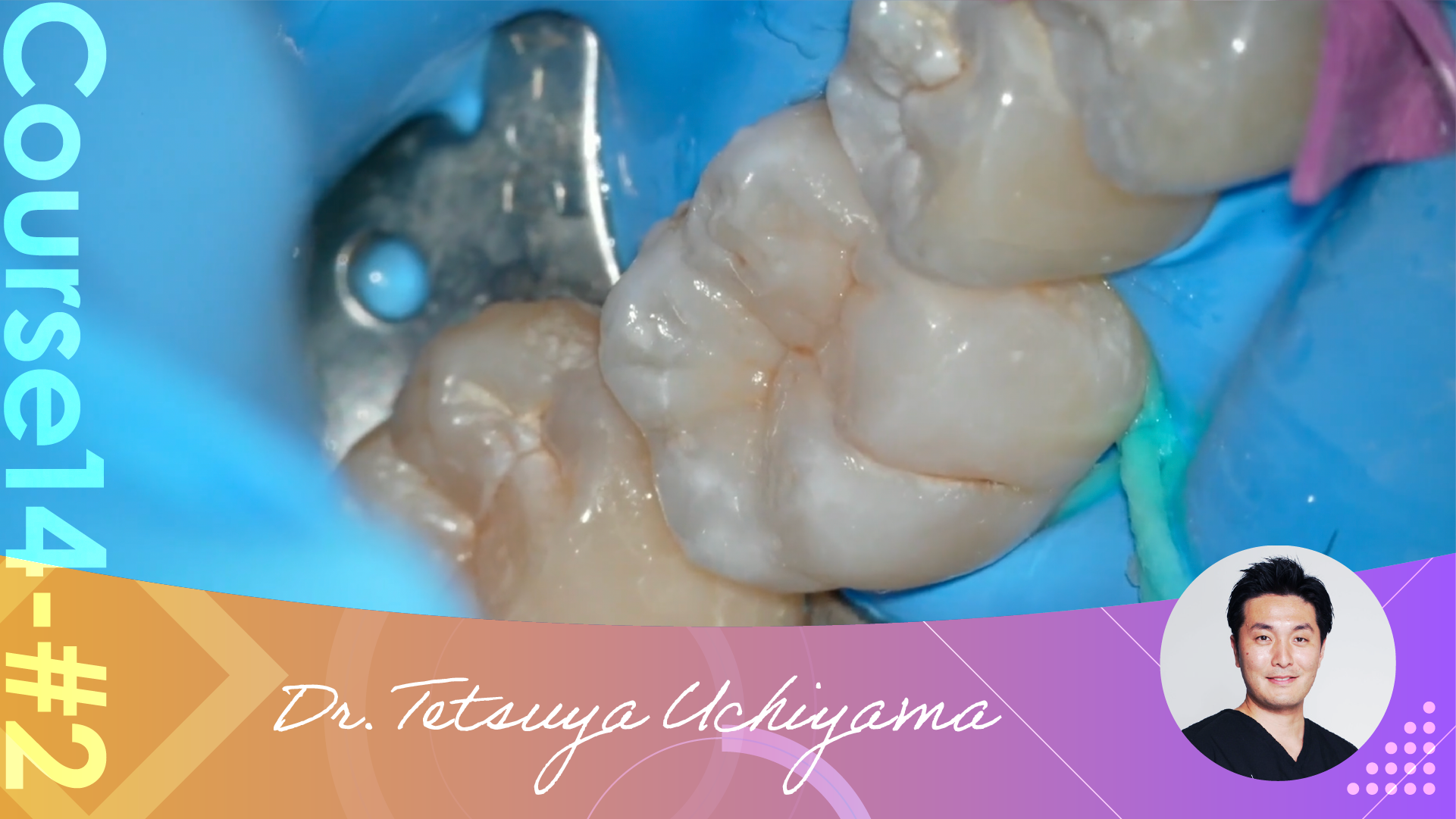 #2 What is sloped Inlay? | Doctorbook global academy