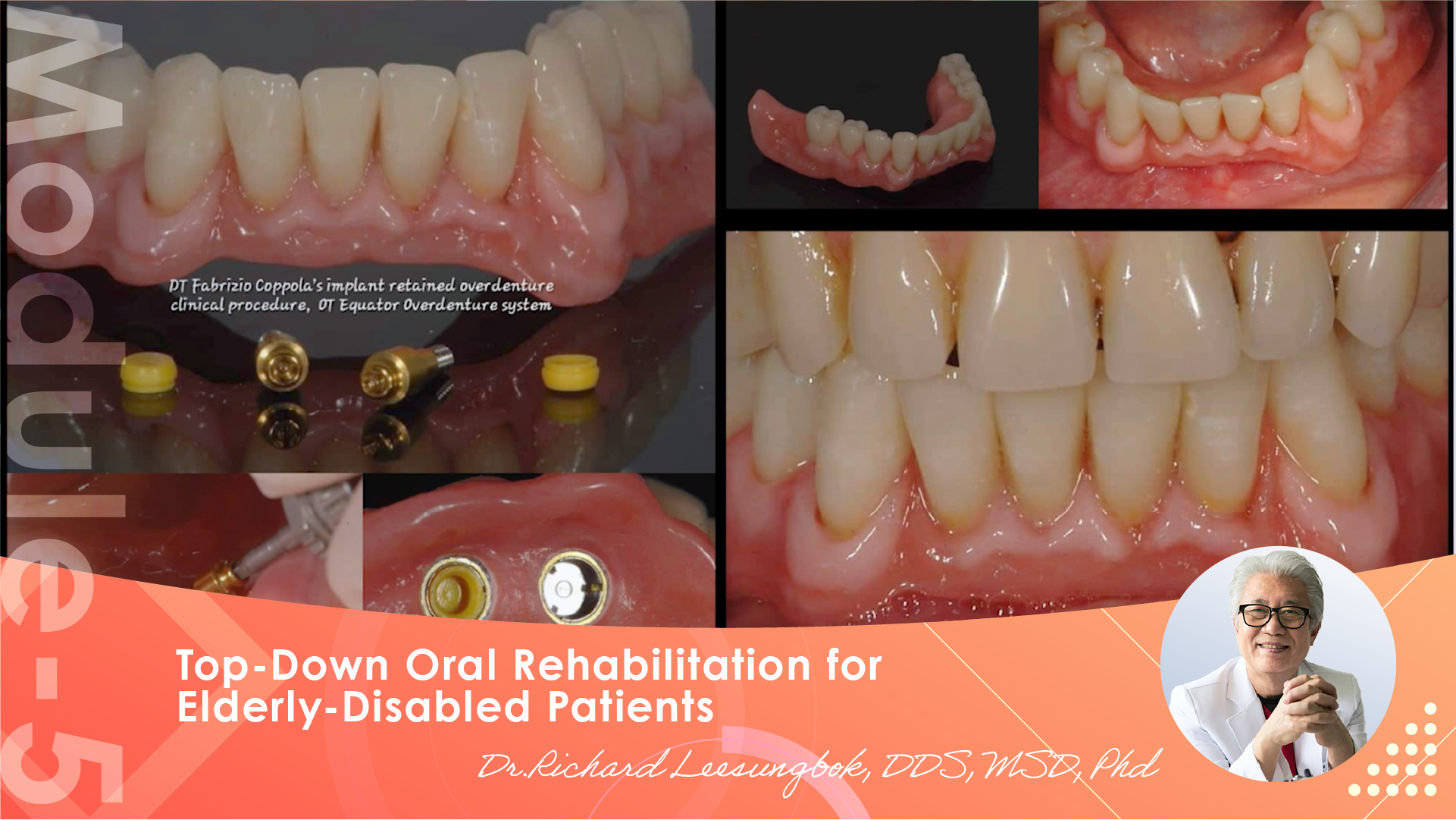Case Presentation on All-on-X Prostheses #2: Selection of Abutment ...