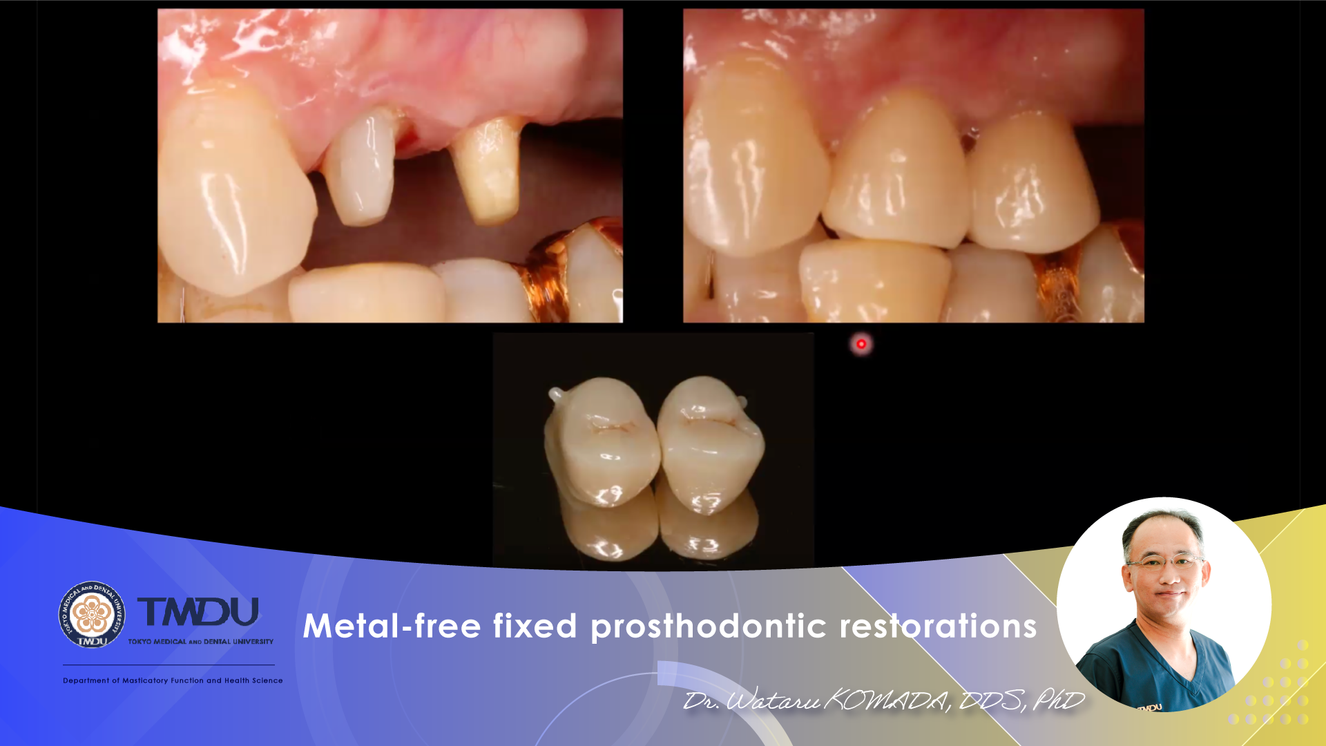Metal-free fixed prosthodontic restorations | Doctorbook global academy