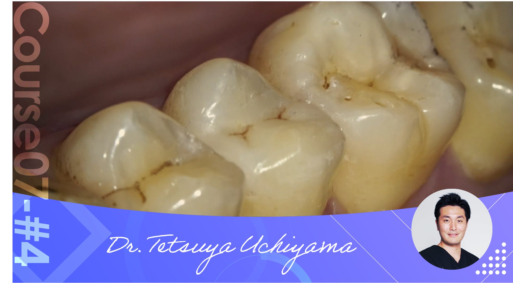 #4 Cementation, clinical case (inlay restoration) | Doctorbook global ...