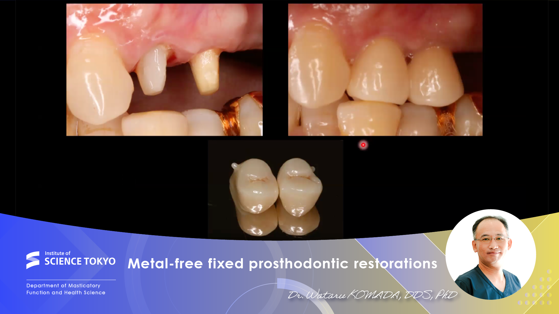 Metal-free fixed prosthodontic restorations | Doctorbook global academy