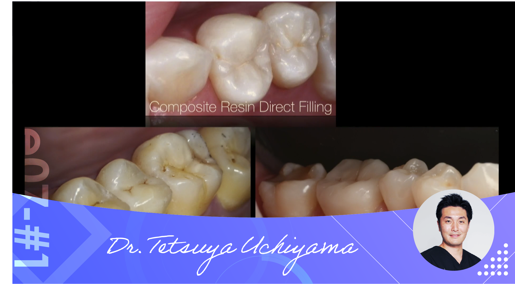 #1 CR restoration or inlay restoration or table top venner | Doctorbook ...