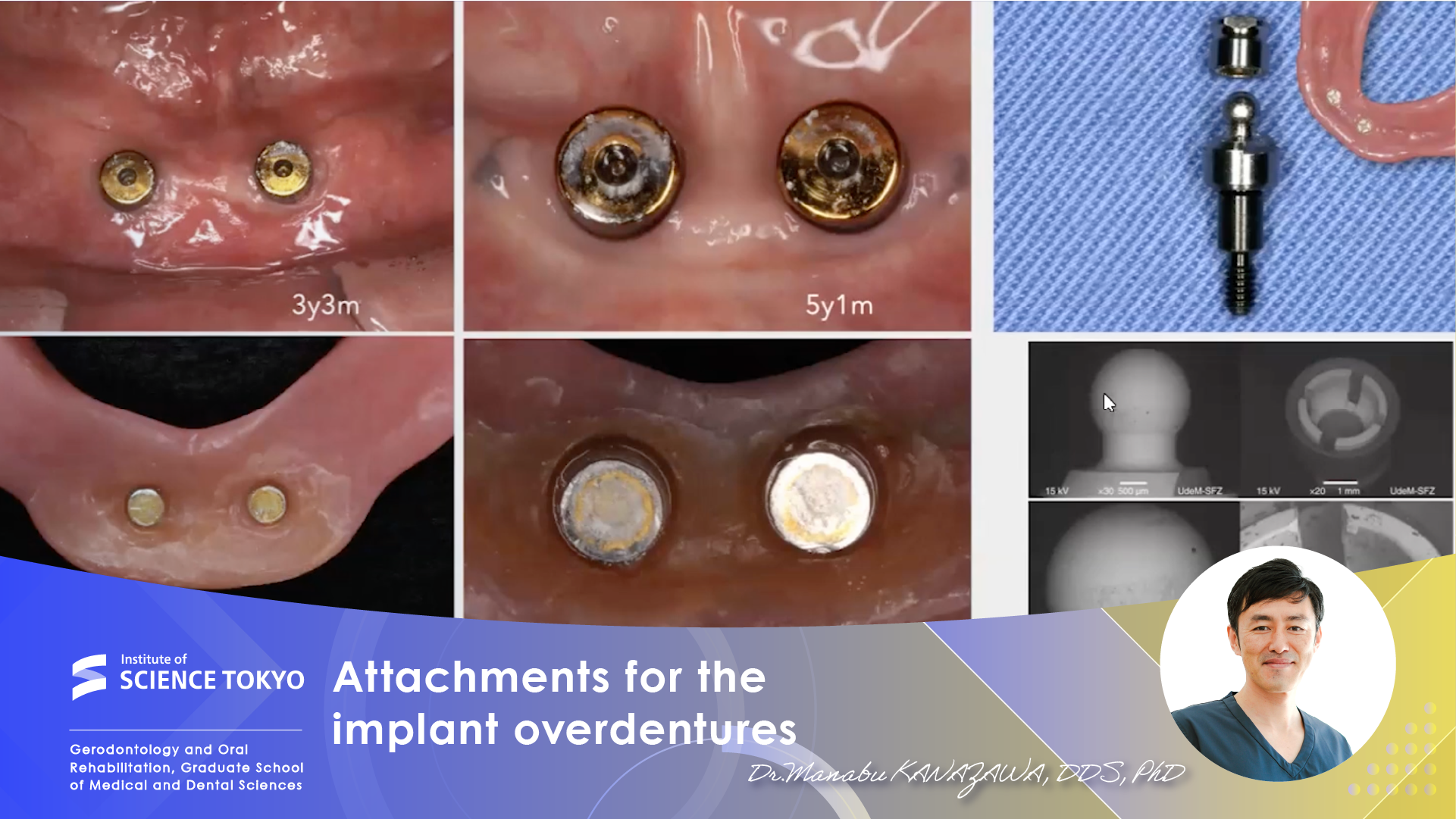 Attachments for the implant overdentures | Doctorbook global academy