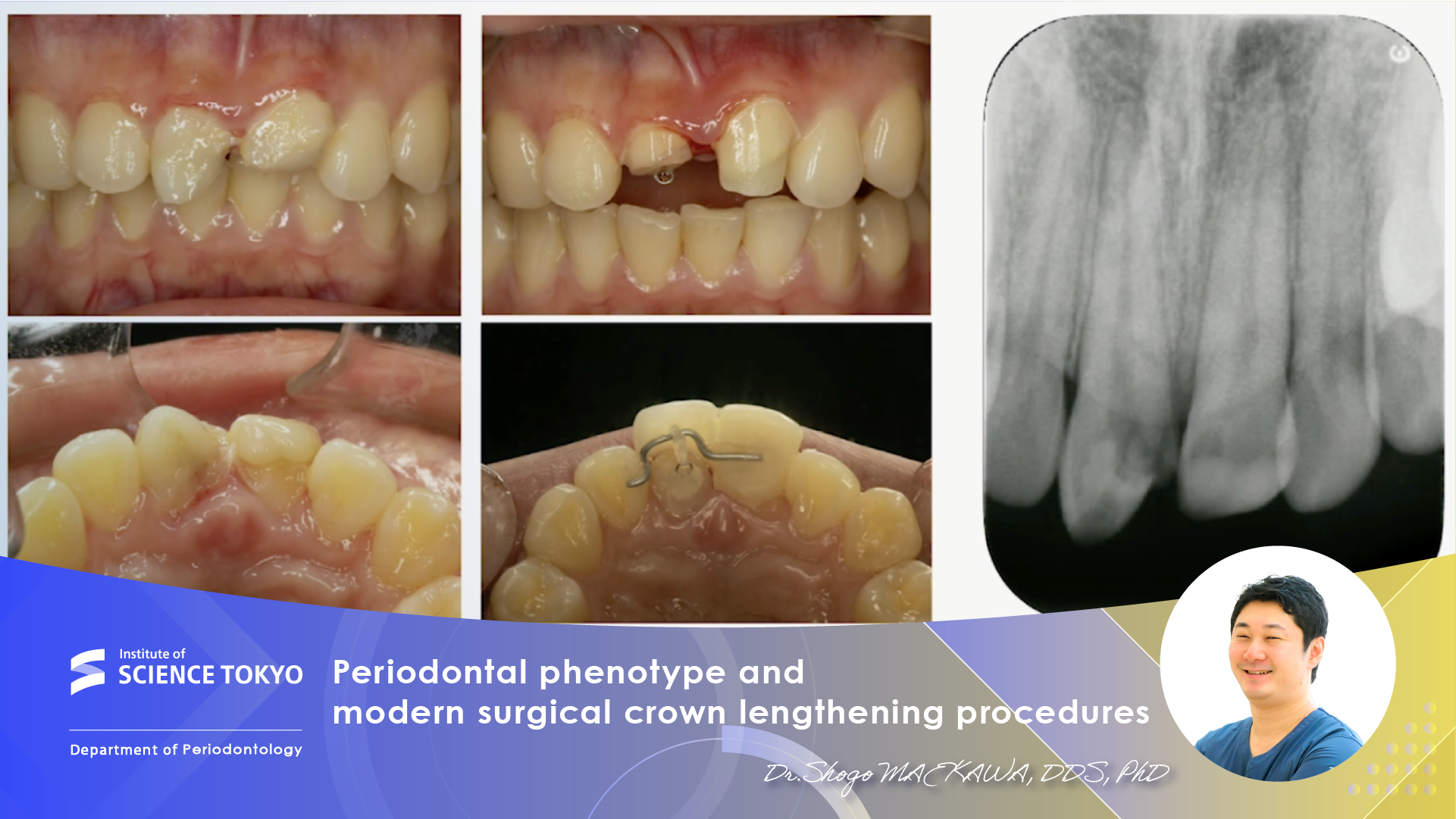 Periodontal phenotype and modern surgical crown lengthening procedures ...