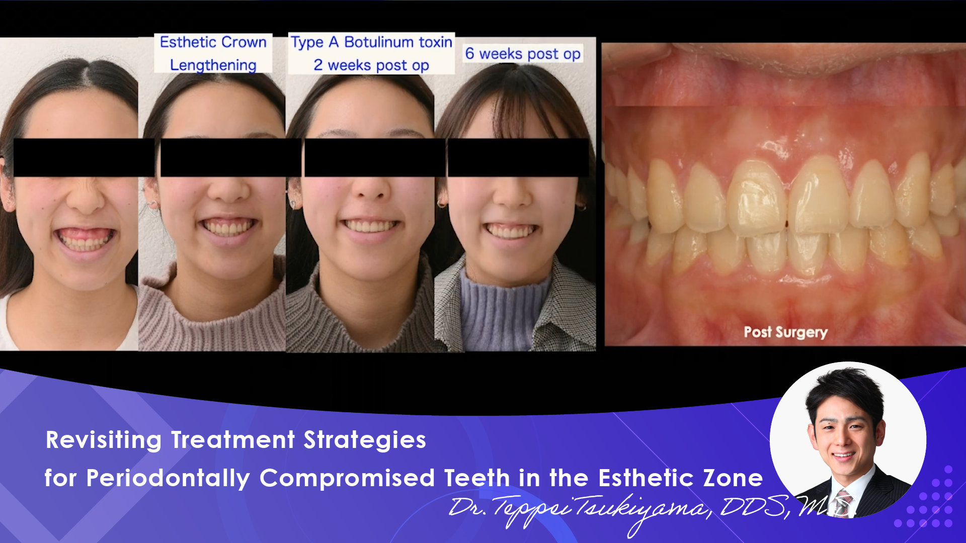 Revisiting Treatment Strategies for Periodontally Compromised Teeth in ...