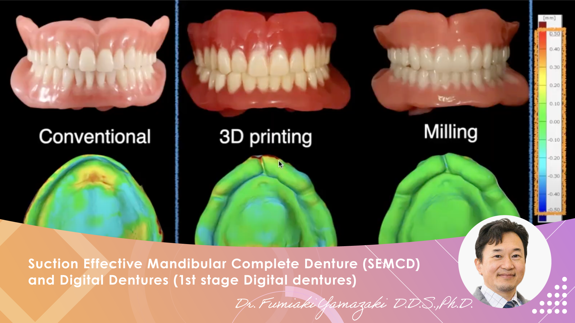 Suction Effective Mandibular Complete Denture (SEMCD) and Digital ...